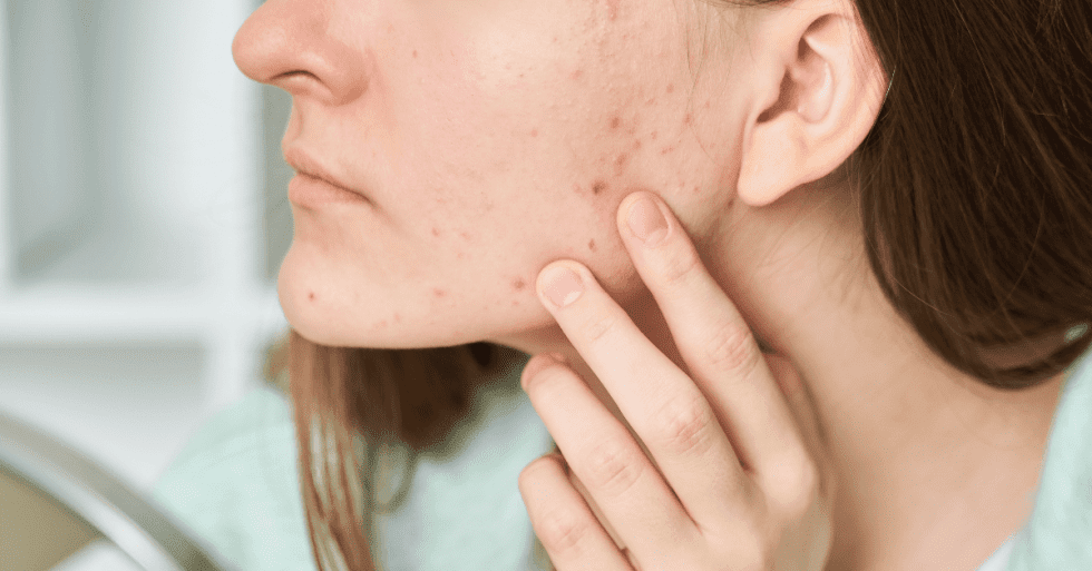How Many Different Kinds of Skin Blemishes Do We Know Of?