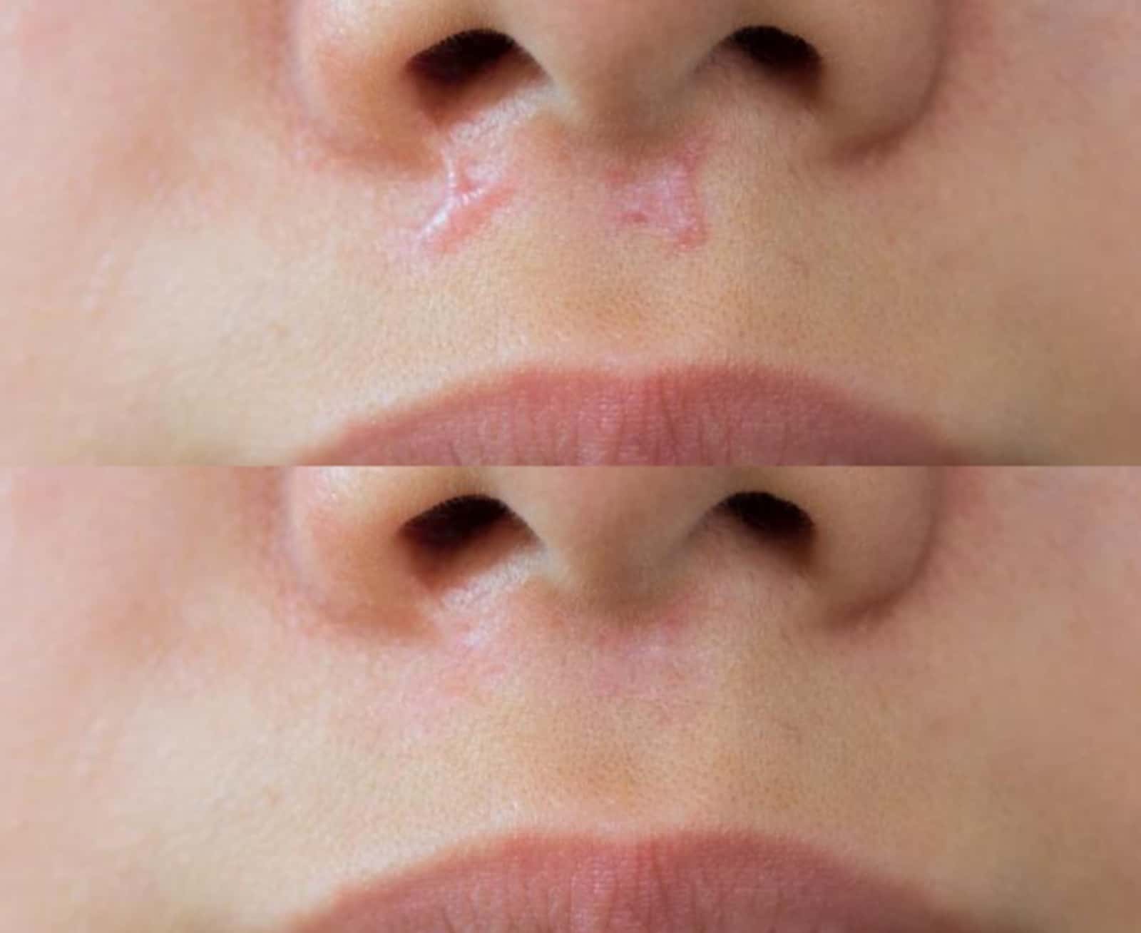 Scar Laser Facts: Evidence-Based, Real-Time Guide