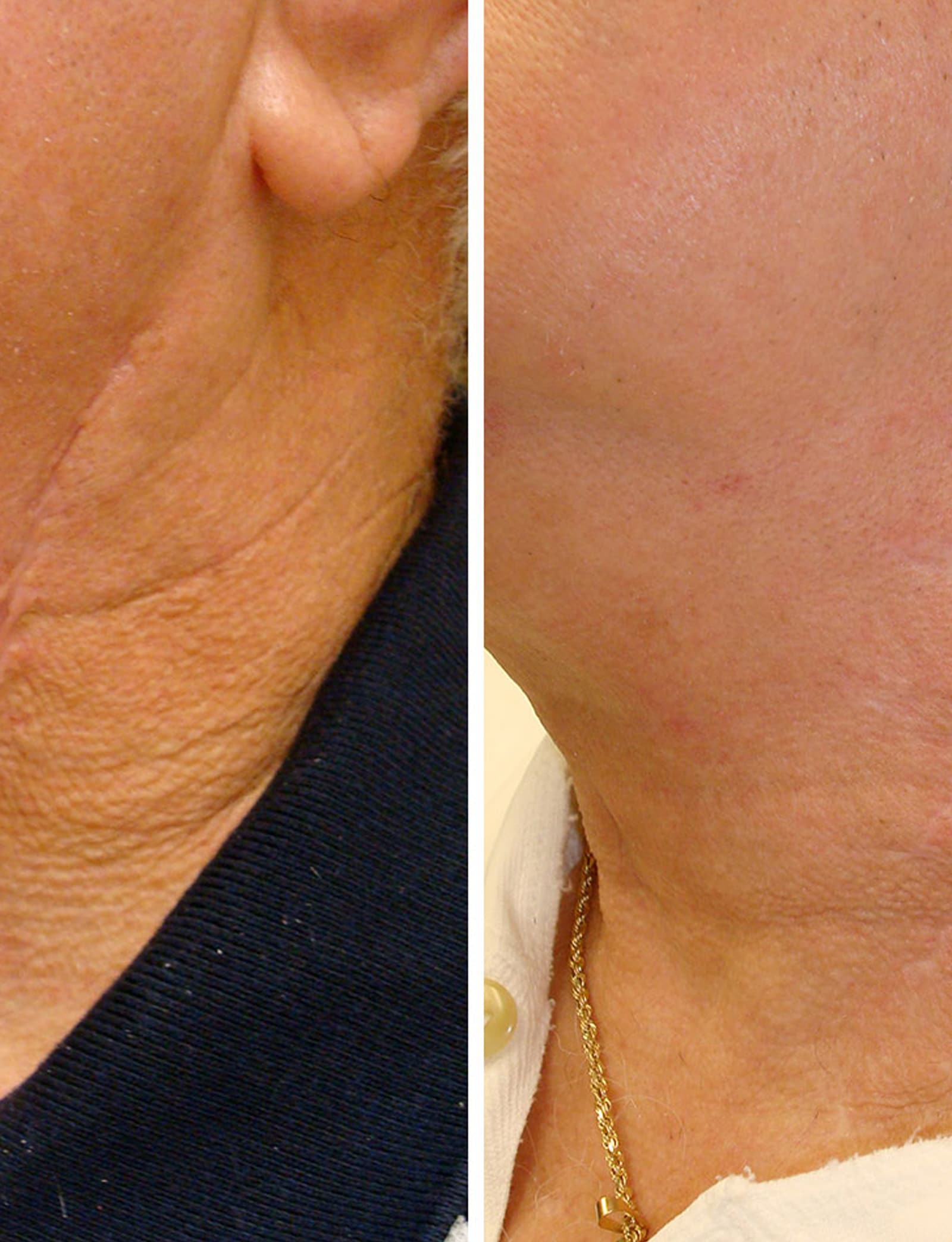 Scar Laser Facts: Evidence-Based, Real-Time Guide