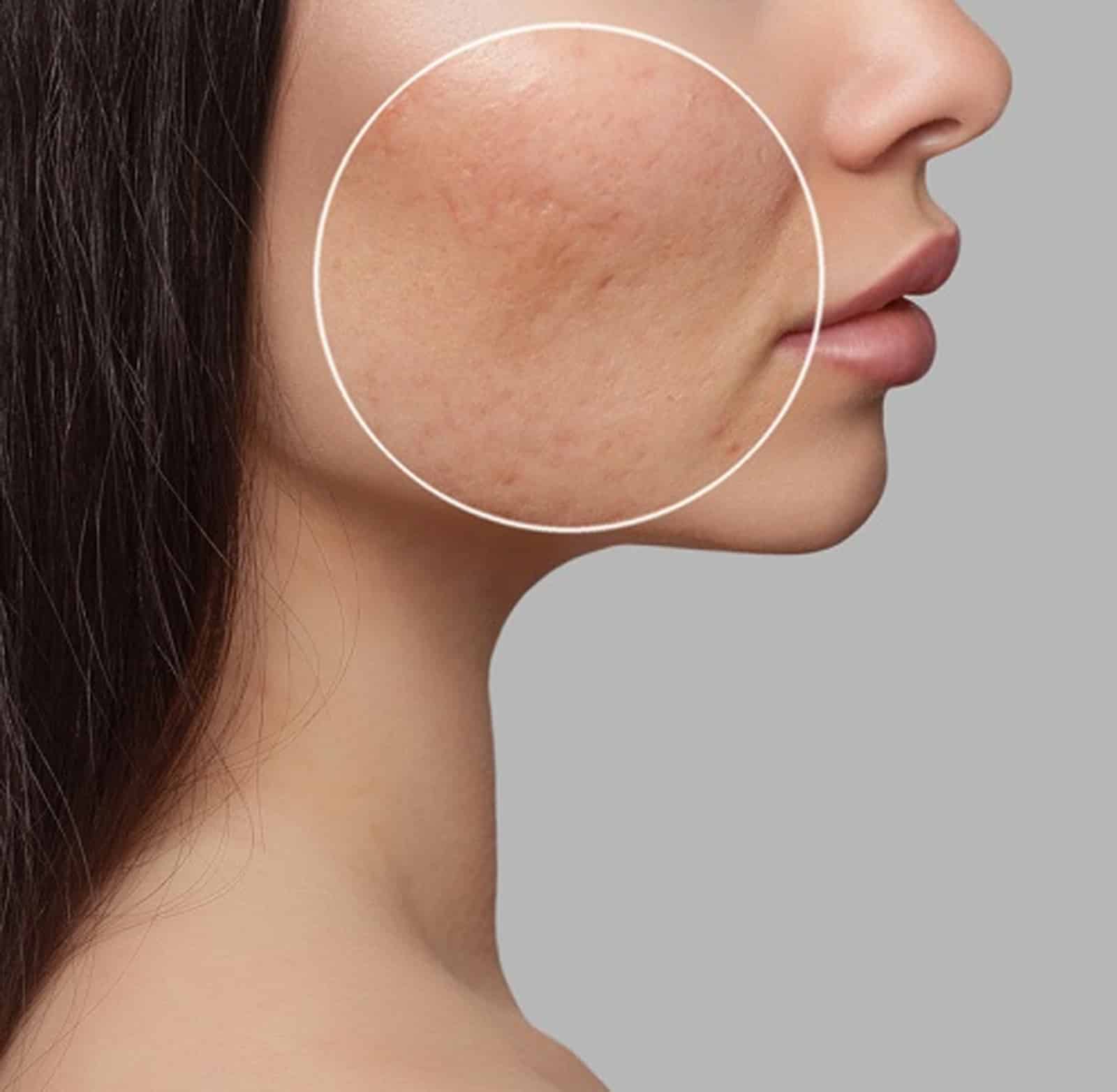 Scar Laser Facts: Evidence-Based, Real-Time Guide